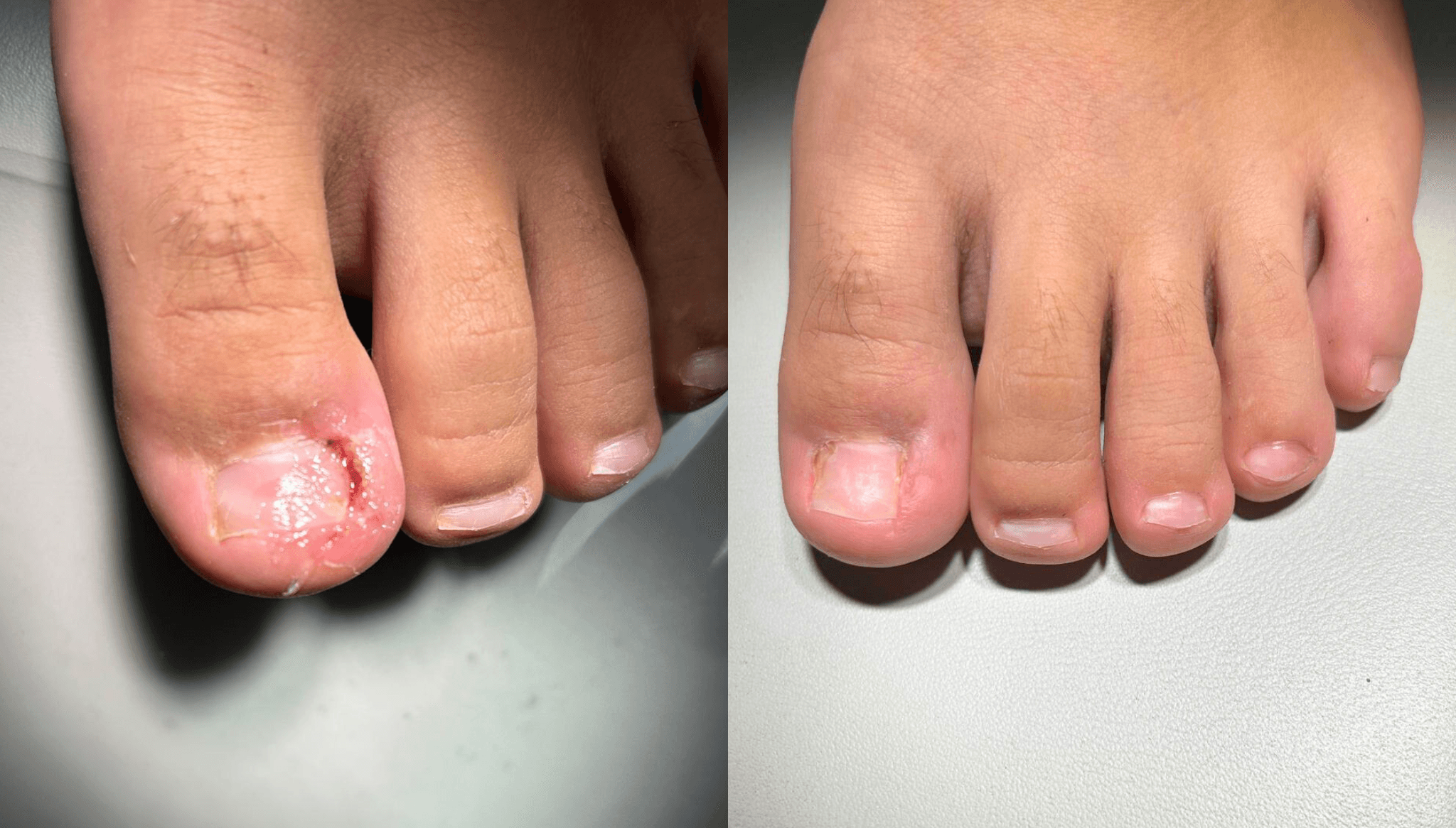 Elimina la onicocriptosis y vuelve a caminar sin dolor - Dénia.com